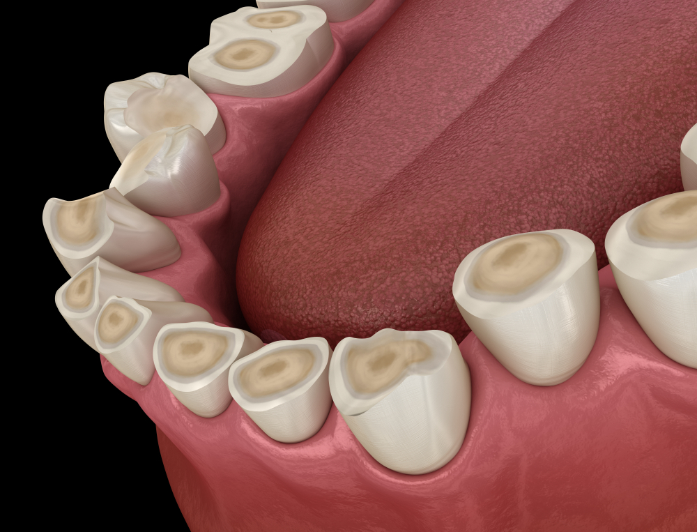 How Bruxism Can be a Good Option?